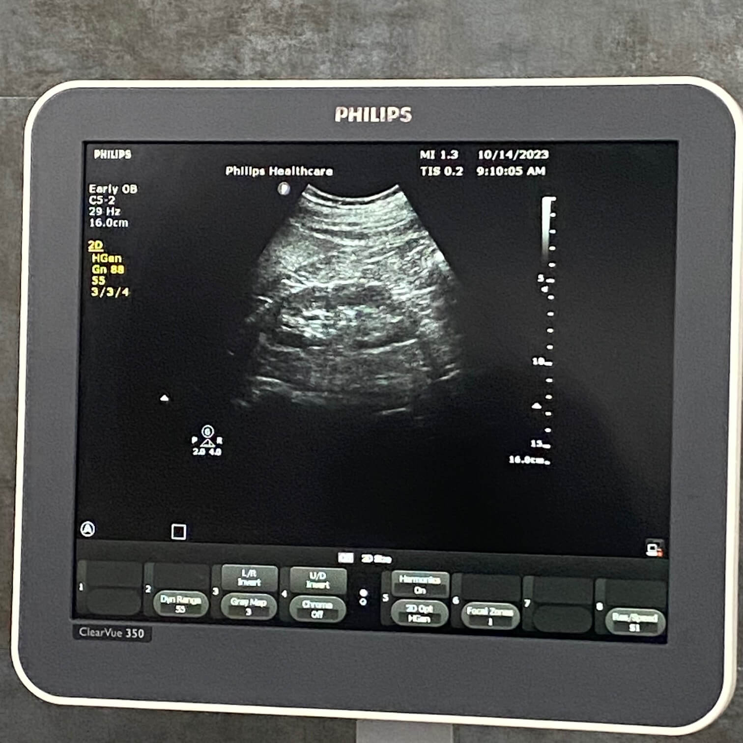 Phillips Ultrasound Transducers for ClearVue