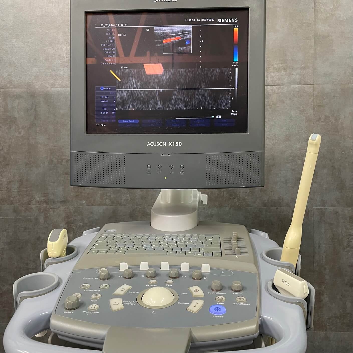 Siemens Acuson X150 Diangostic Ultrasound - – Angelus Medical and Optical